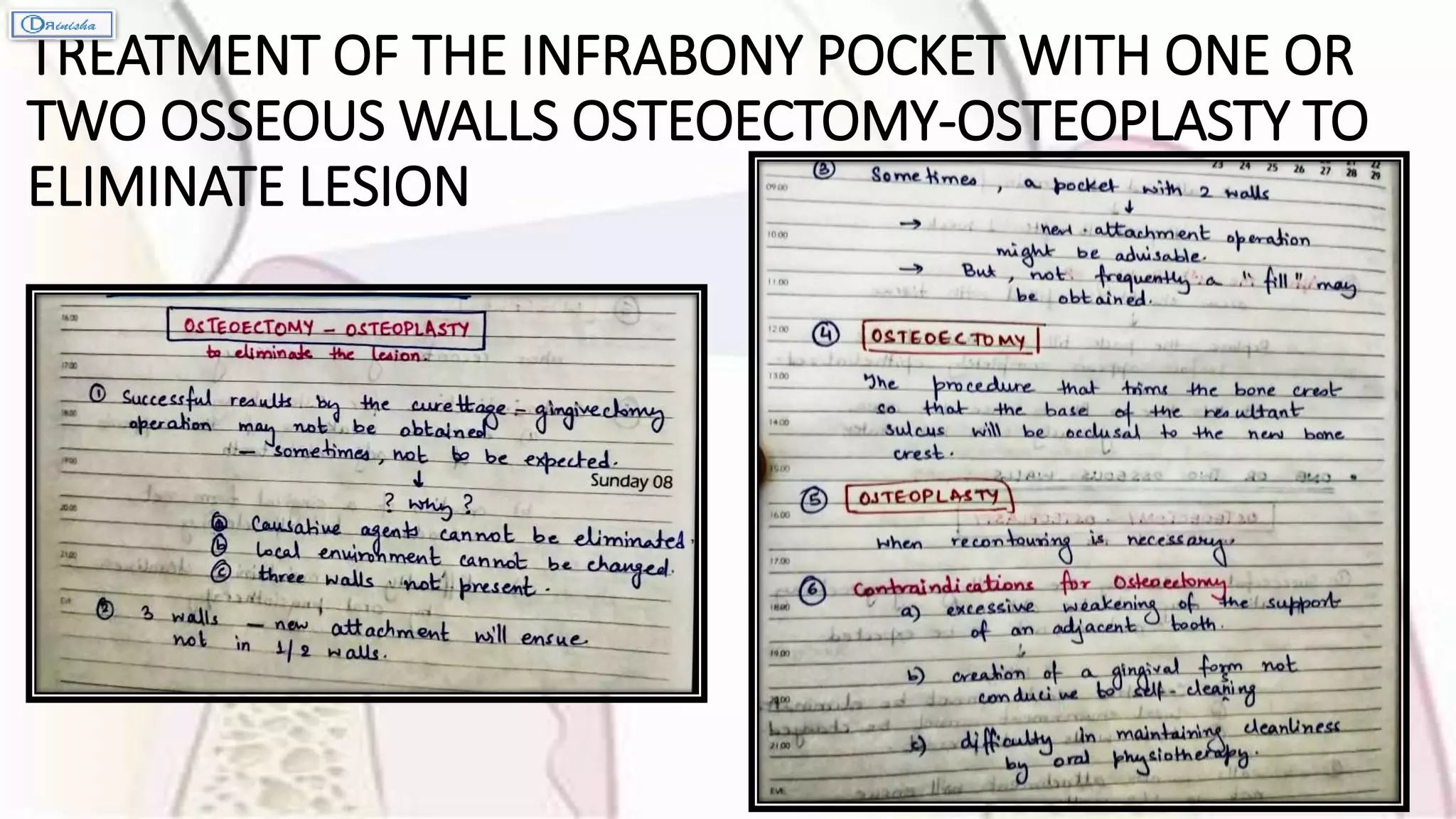 Treatment of Infrabony Pockets.pptx