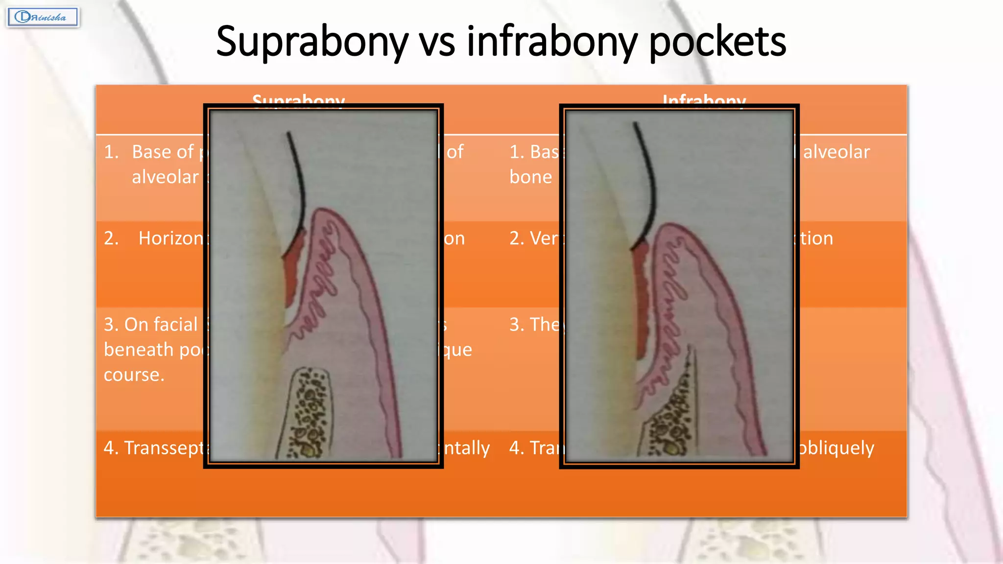 Treatment of Infrabony Pockets.pptx