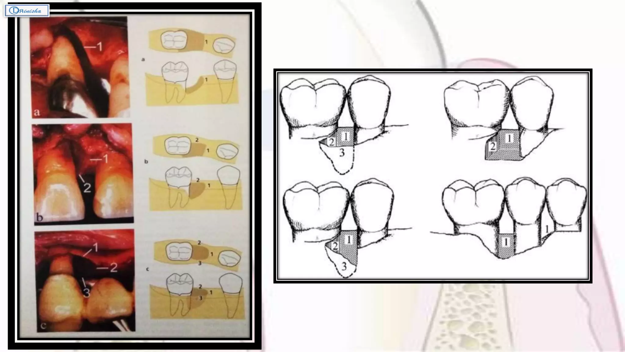 Treatment of Infrabony Pockets.pptx