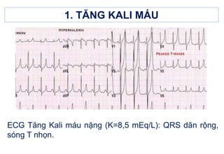 10. ECG RỐI LOẠN ĐIỆN GIẢI.ppt