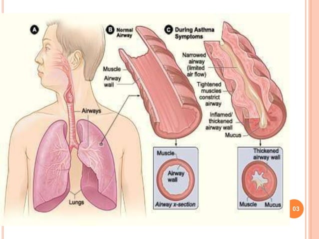 10. asthma.pptx