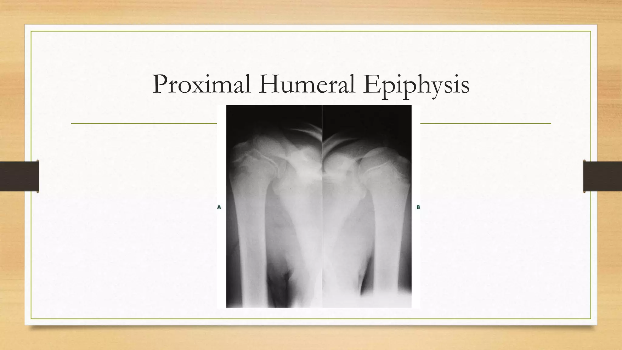 Humerus Fractures | PPTX