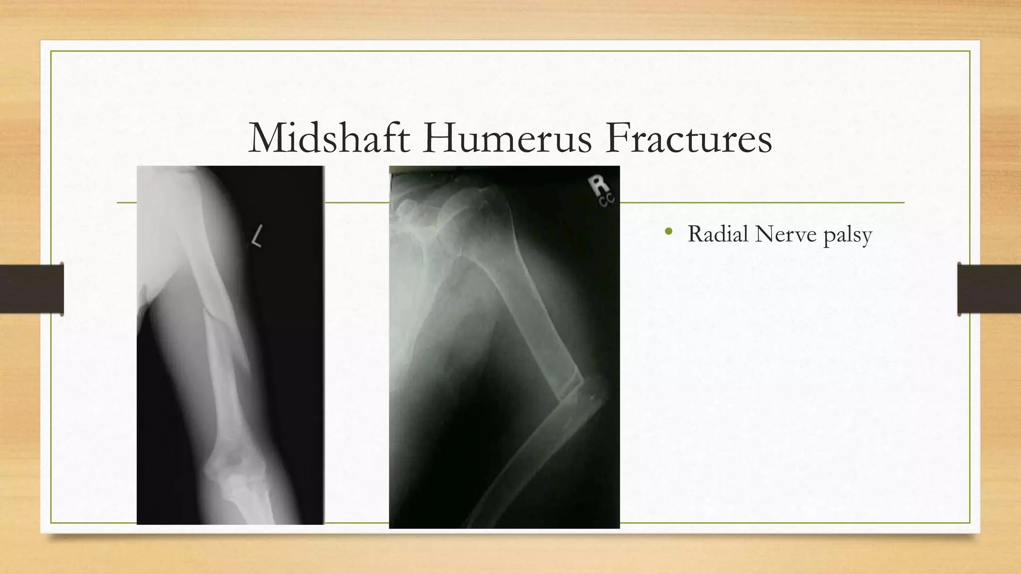 Humerus Fractures | PPTX