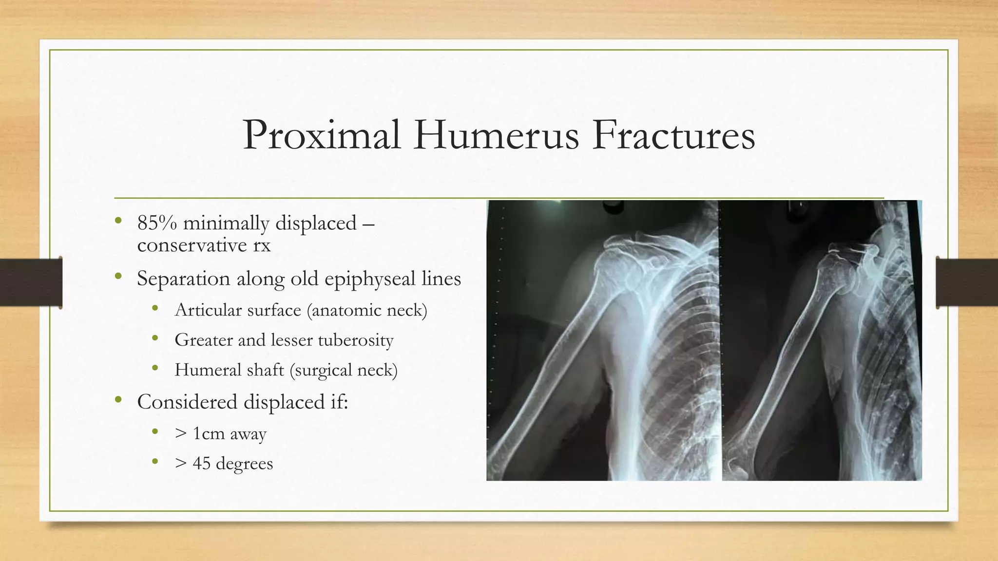 Humerus Fractures | PPTX
