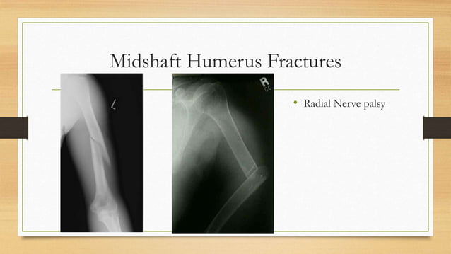 Humerus Fractures | PPT