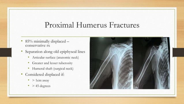 Humerus Fractures | PPT