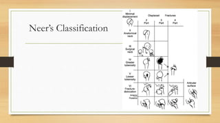 Humerus Fractures | PPTX
