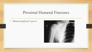 Humerus Fractures | PPTX