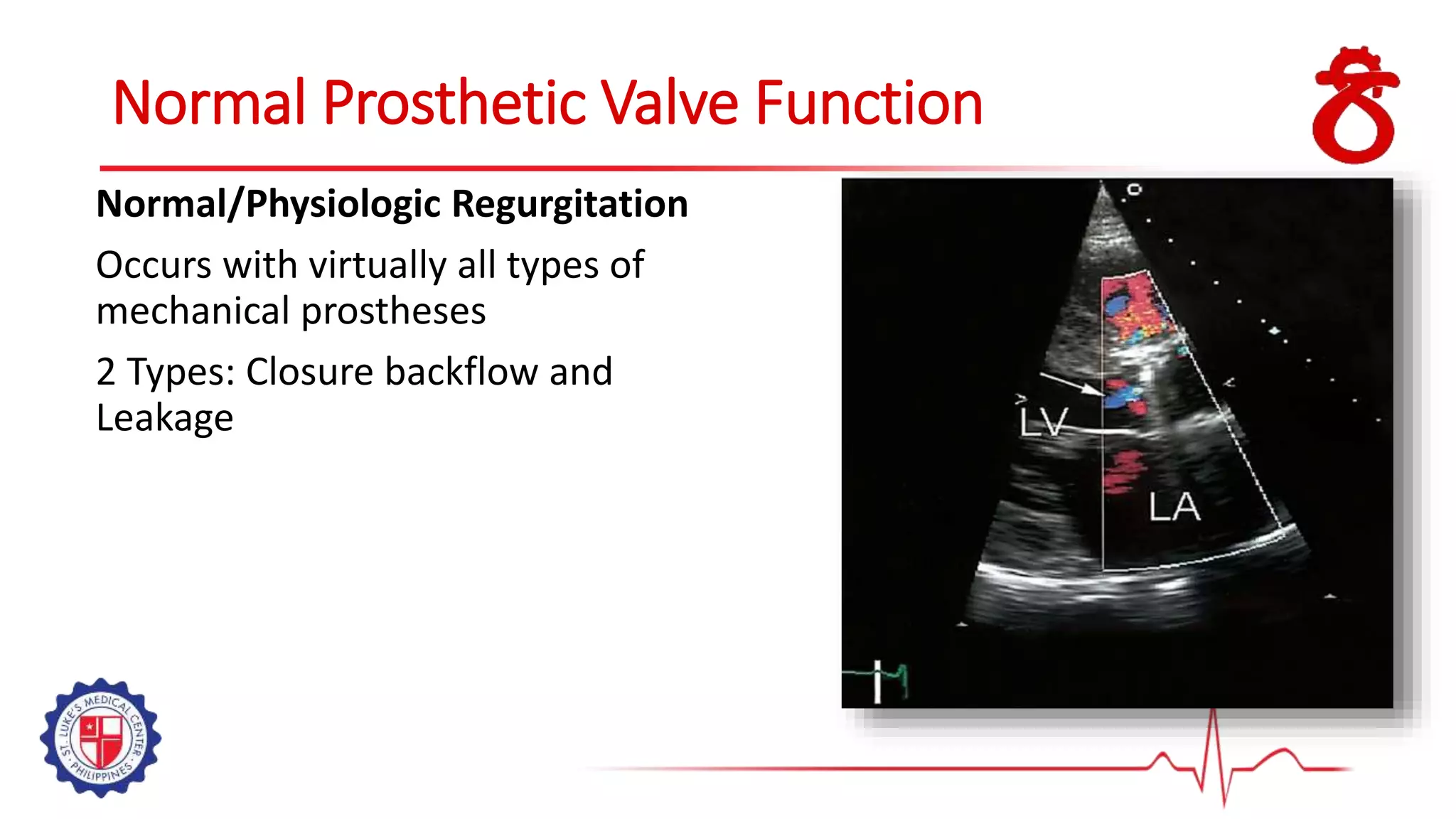 10.8.21 ECHO Normal prosthetic valve - FLOREN.pptx