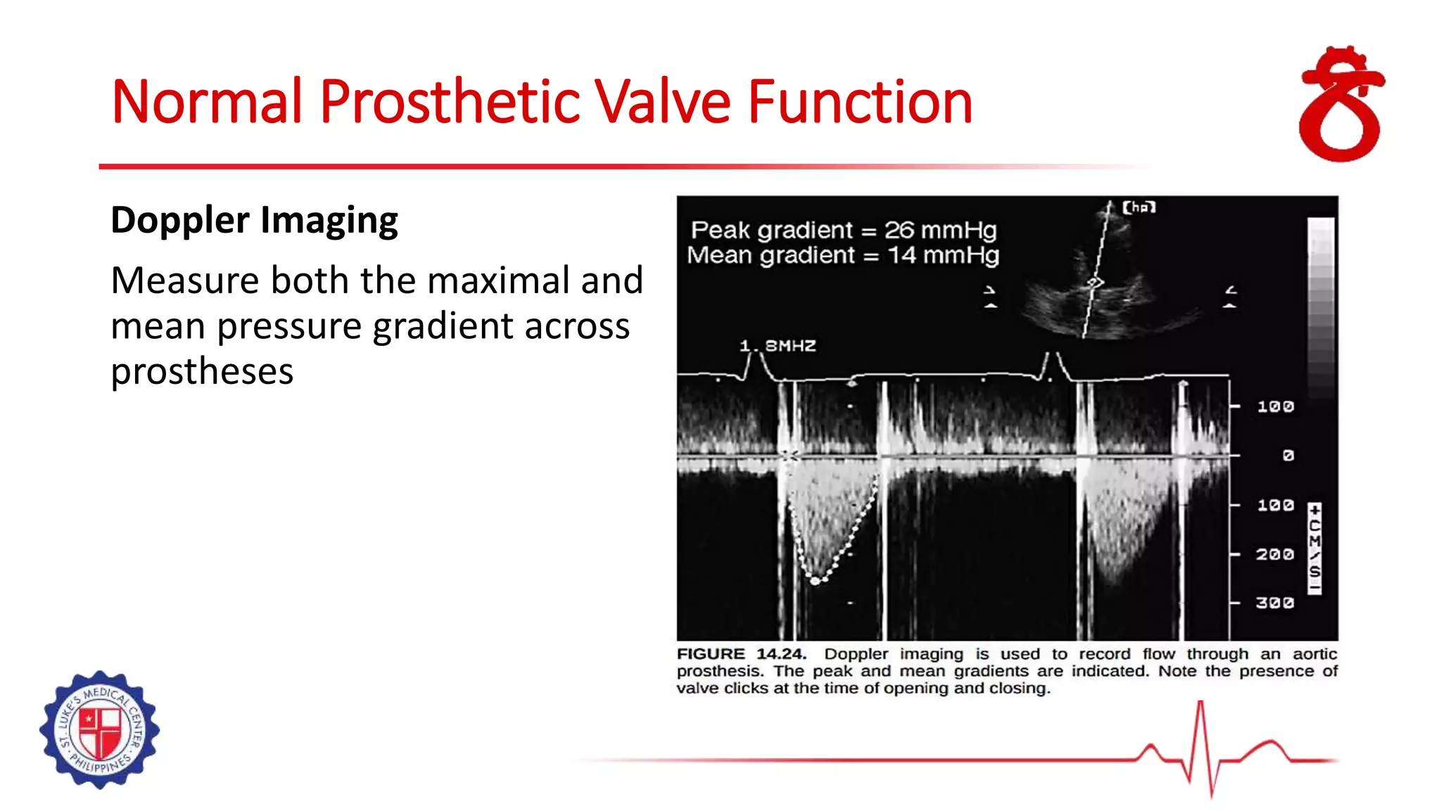 10.8.21 ECHO Normal prosthetic valve - FLOREN.pptx