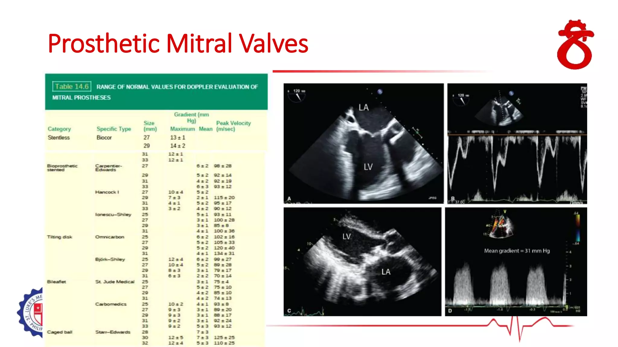 10.8.21 ECHO Normal prosthetic valve - FLOREN.pptx