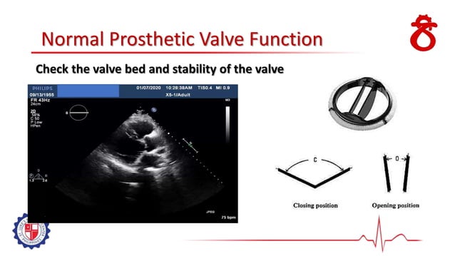10.8.21 ECHO Normal prosthetic valve - FLOREN.pptx