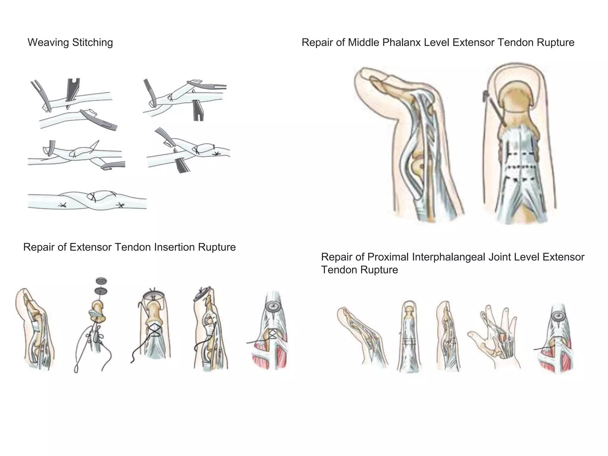 10. Damage to tendon .pptx
