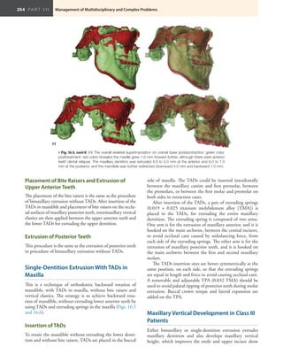 Orthognathic Camouflage With TADs for Improving Facial Profile in Class ...