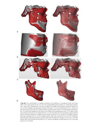 Orthognathic Camouflage With TADs for Improving Facial Profile in Class ...