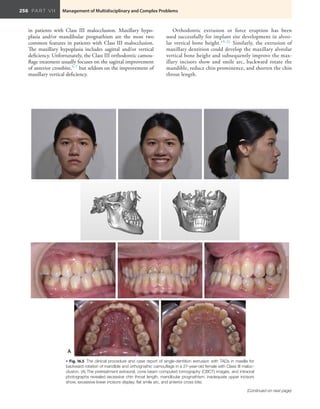 Orthognathic Camouflage With TADs for Improving Facial Profile in Class ...