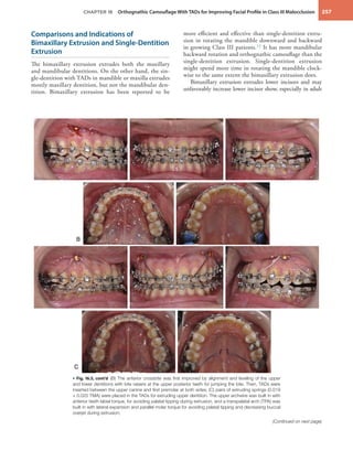 Orthognathic Camouflage With TADs for Improving Facial Profile in Class ...