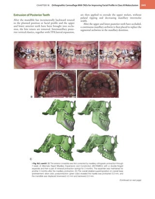 Orthognathic Camouflage With TADs for Improving Facial Profile in Class ...