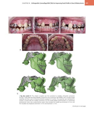 Orthognathic Camouflage With TADs for Improving Facial Profile in Class ...