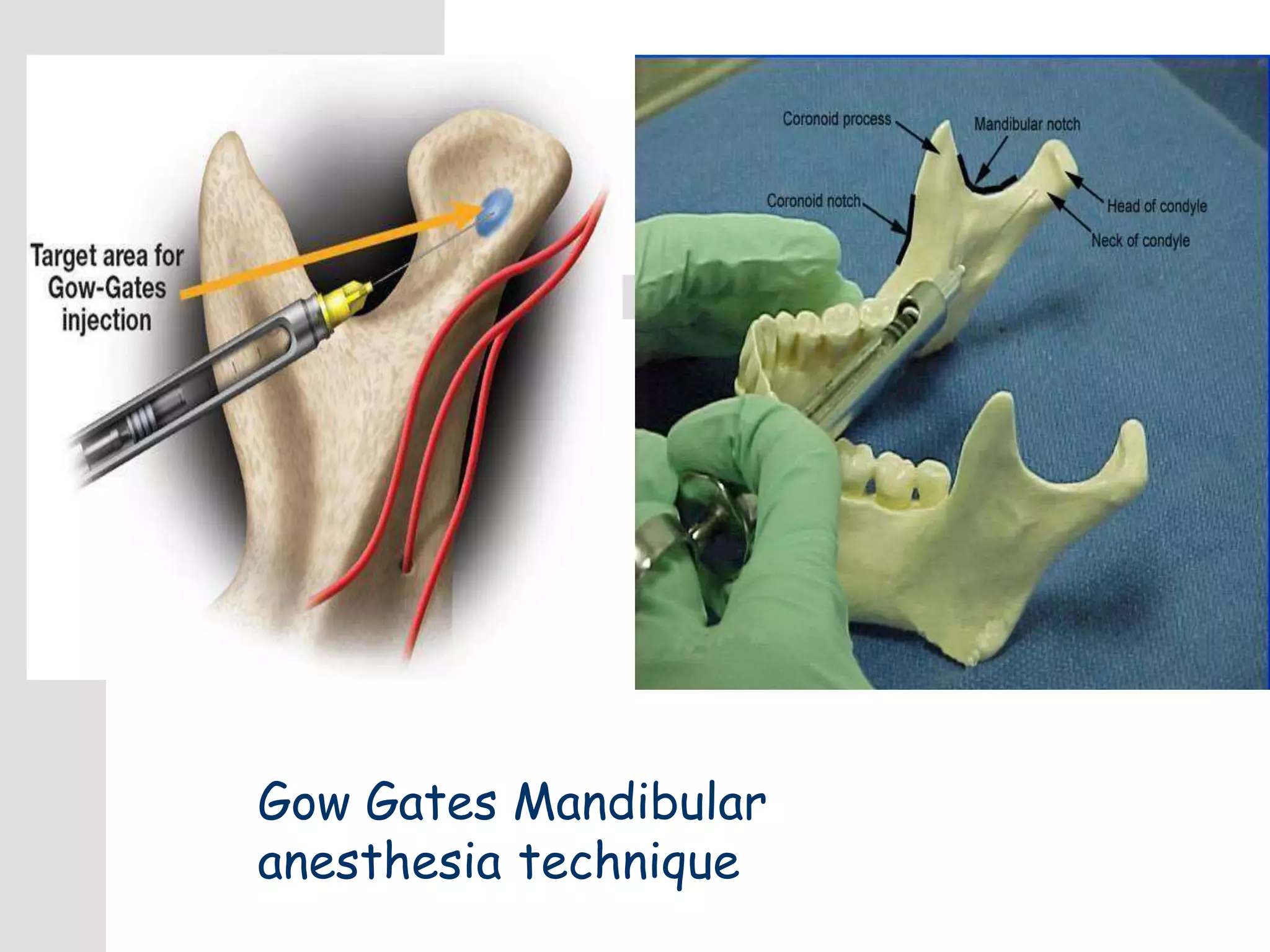 10. mandibular anesthesia.pptx