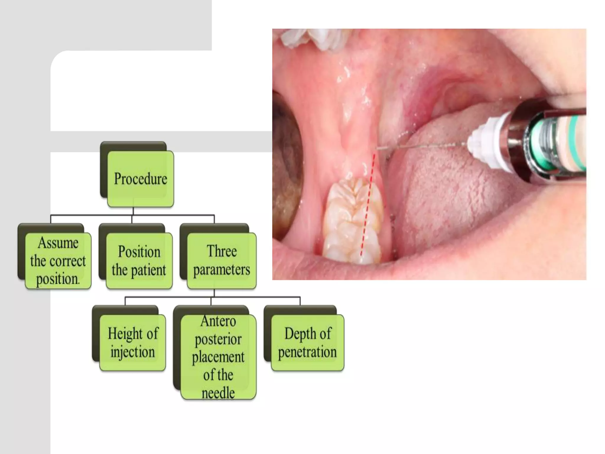 10. mandibular anesthesia.pptx