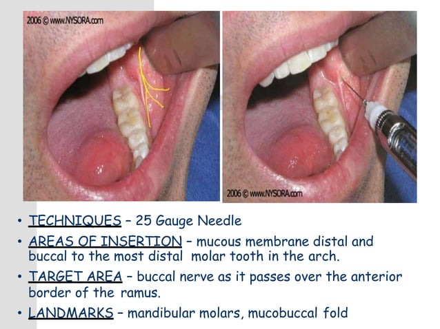 10. mandibular anesthesia.pptx
