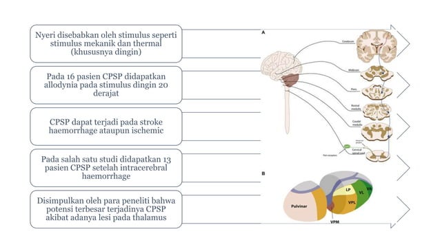 10. Central Post Stroke Pain.pptx