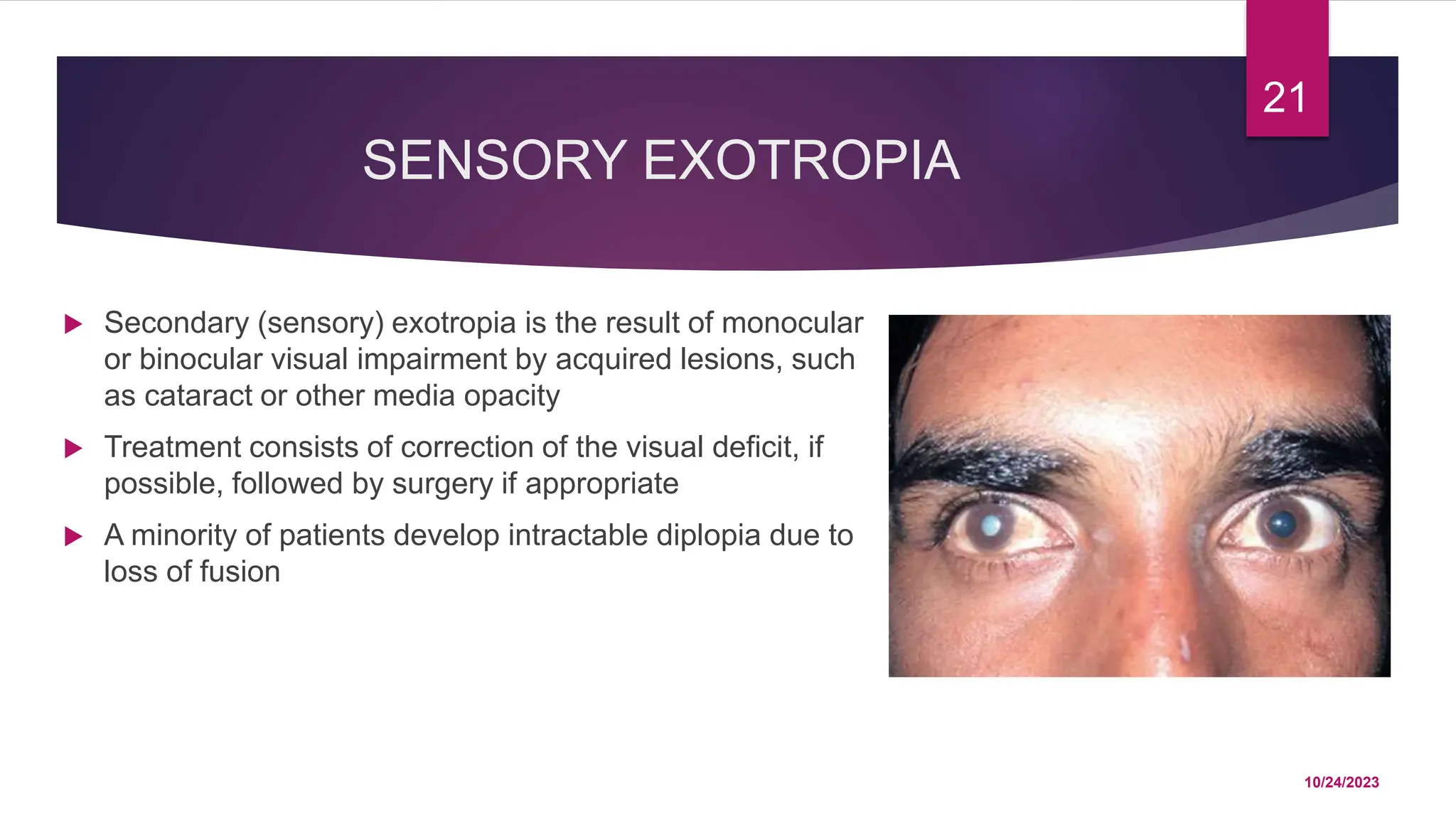 EXOTROPIA.pptx