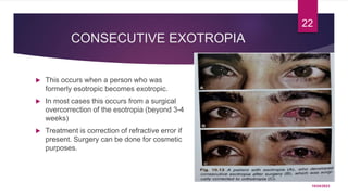 EXOTROPIA.pptx
