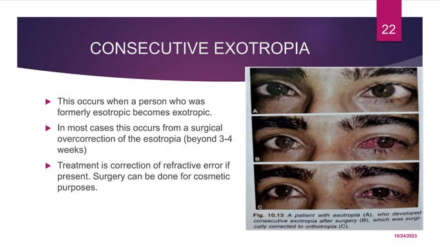 EXOTROPIA.pptx