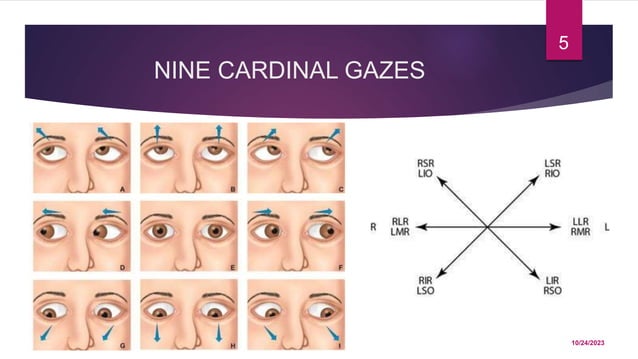 EXOTROPIA.pptx