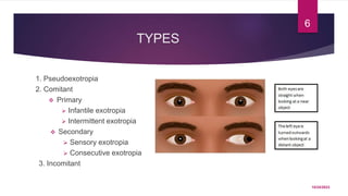 EXOTROPIA.pptx