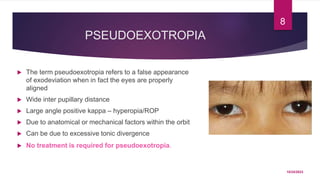EXOTROPIA.pptx