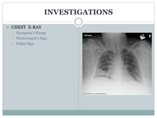 10. Pulmonary Embolism.pptx