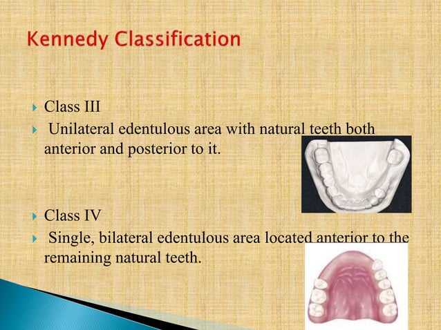 10..Classification RPD in dentistry pptx | PPTX