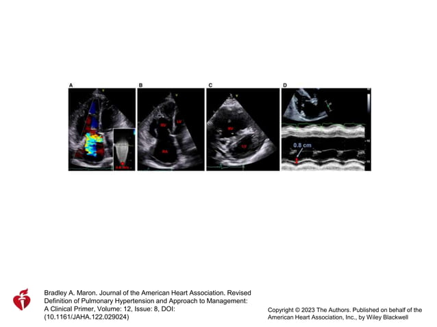 ECHO in pulmonary hypertension JAHA 10.1161 | Lung and Respiratory ...