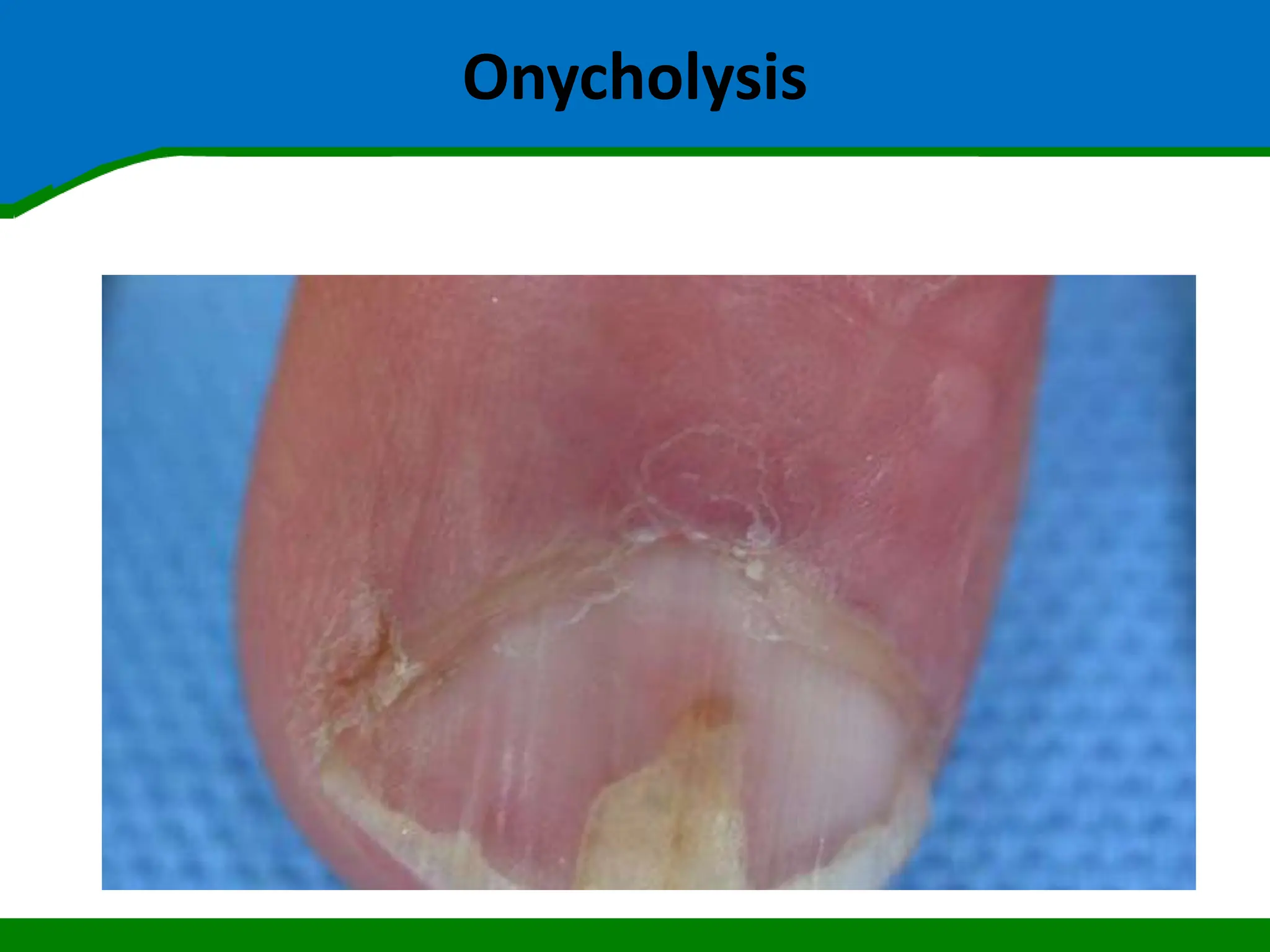 10. nail abnormalities.pptx Dermatolohgy | PPTX | Nail Care | Beauty