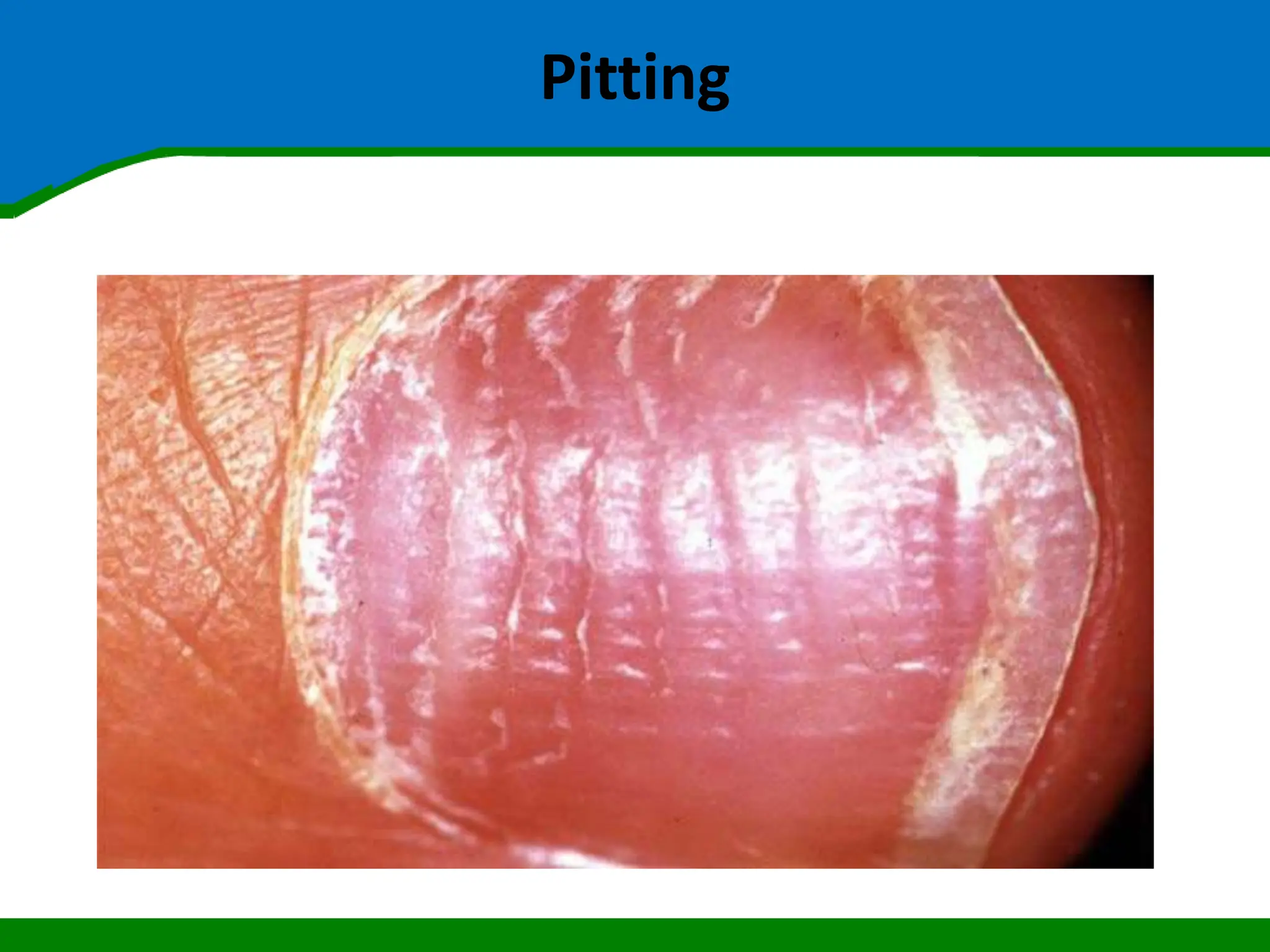 10. nail abnormalities.pptx Dermatolohgy | PPTX | Nail Care | Beauty