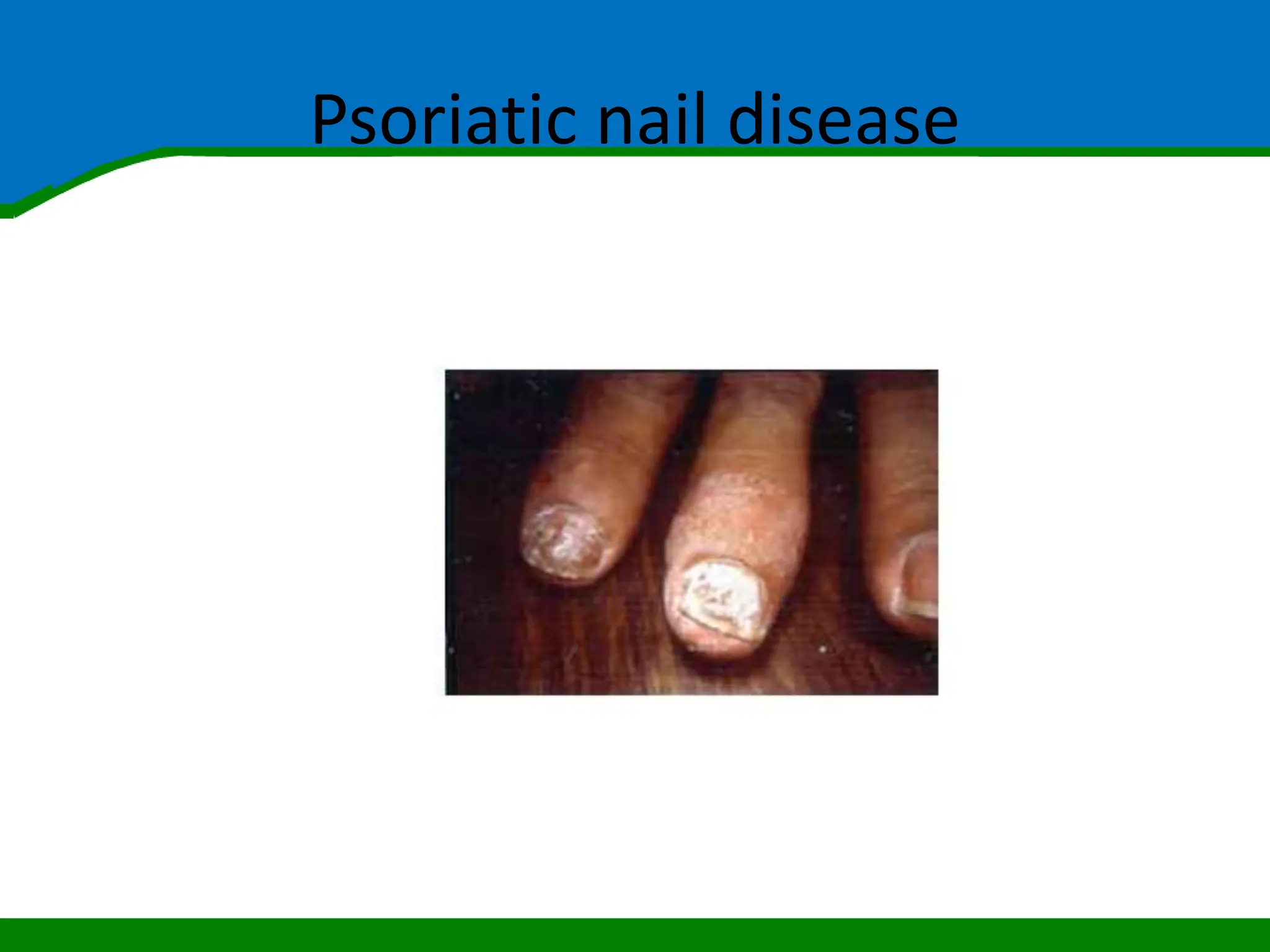 10. nail abnormalities.pptx Dermatolohgy | PPTX | Nail Care | Beauty