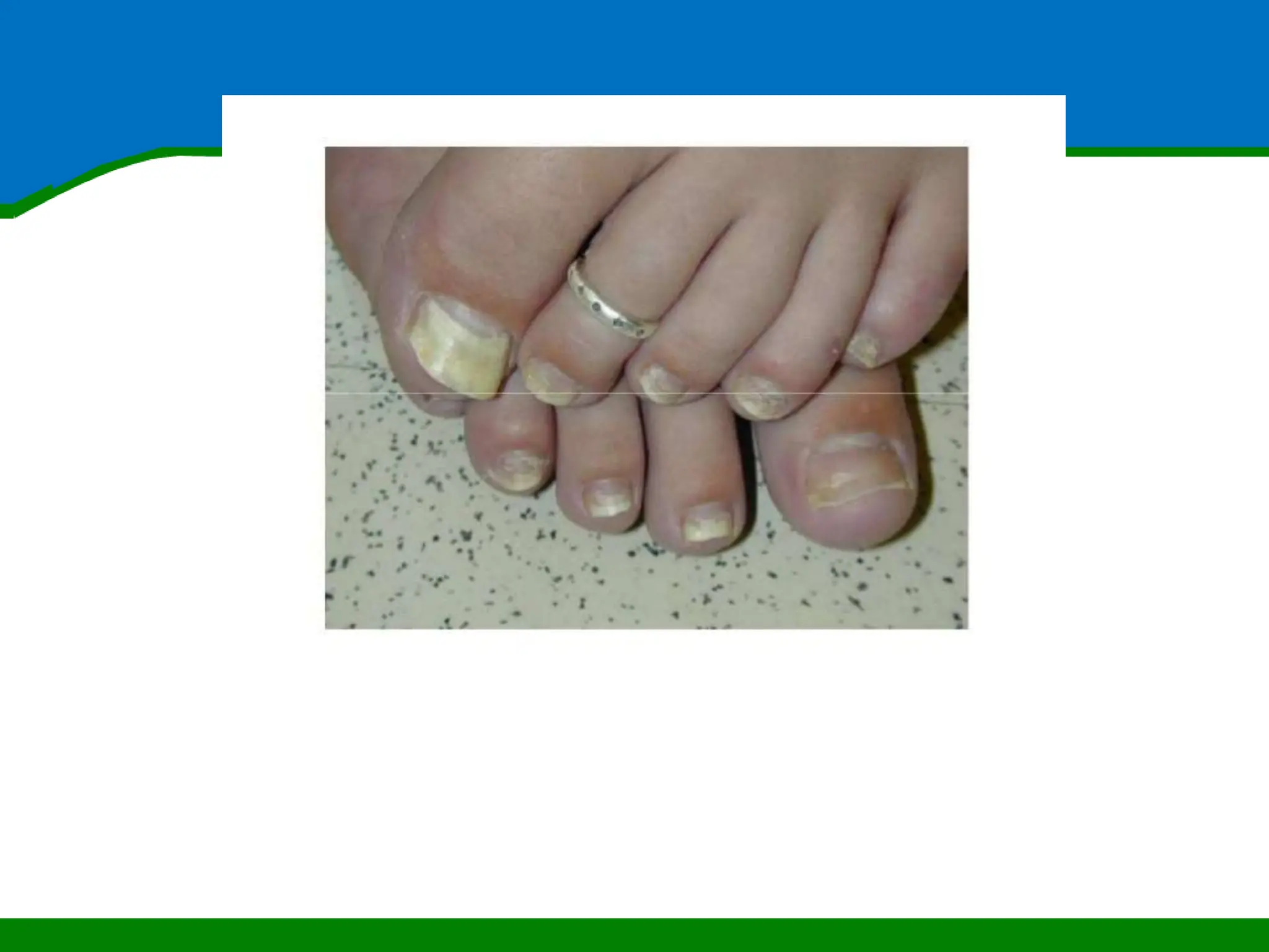 10. nail abnormalities.pptx Dermatolohgy | PPTX | Nail Care | Beauty