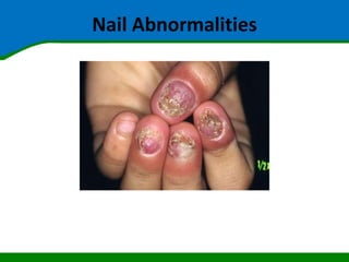 10. nail abnormalities.pptx Dermatolohgy | PPT
