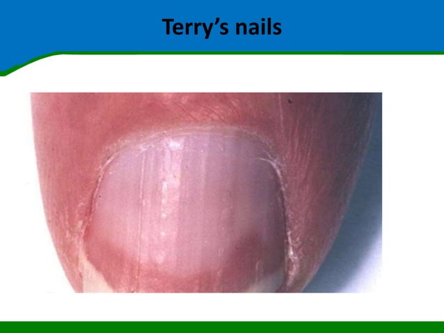 10. nail abnormalities.pptx Dermatolohgy | PPTX | Nail Care | Beauty