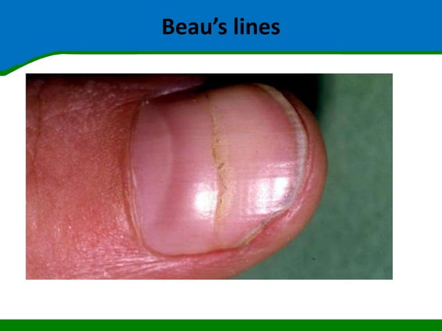 10. nail abnormalities.pptx Dermatolohgy | PPTX | Nail Care | Beauty