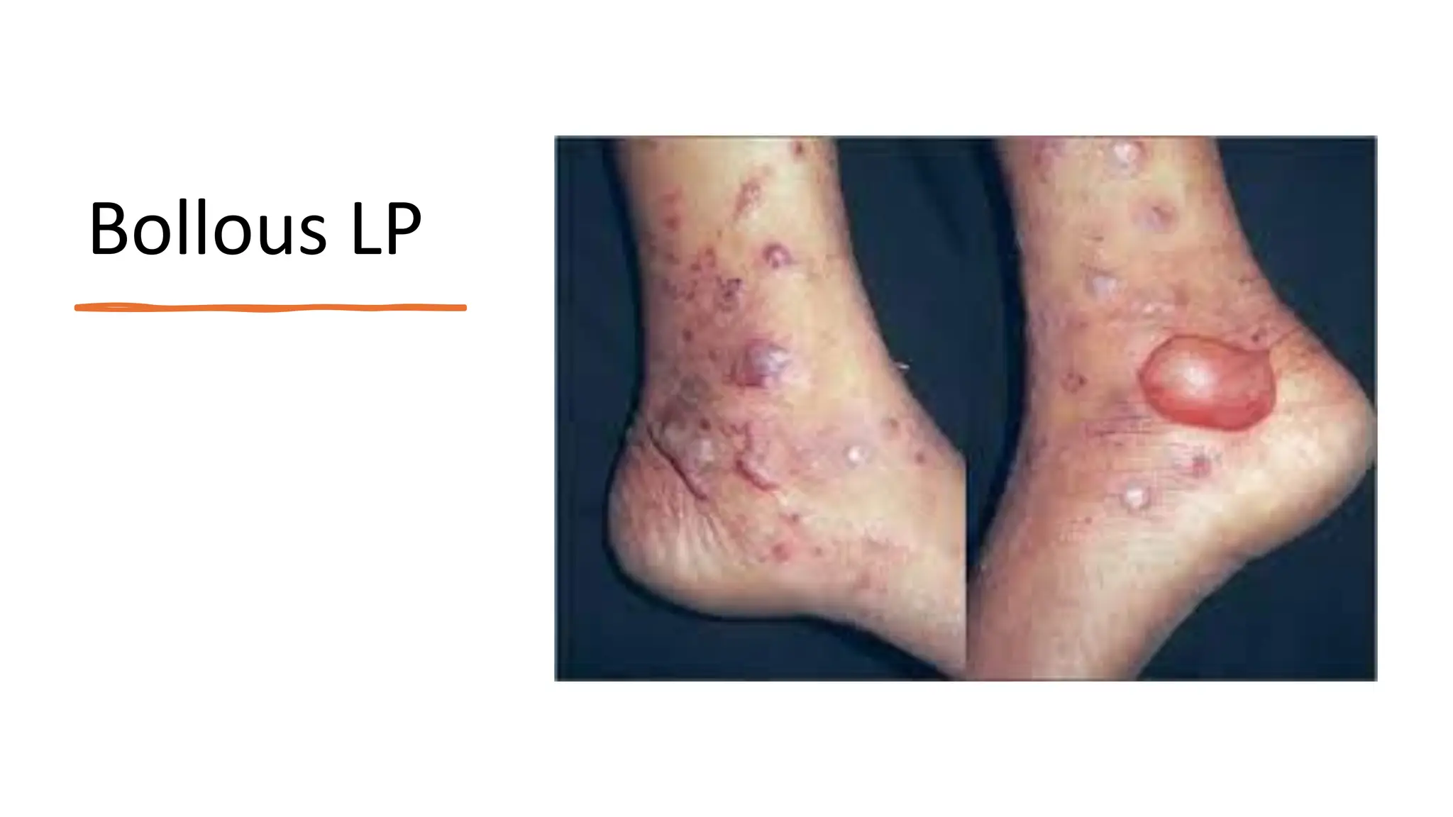 Lichen Planus disease - Dermatology speciality | PPT