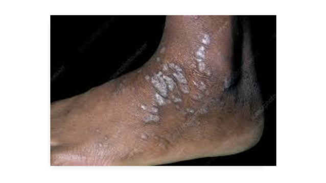 Lichen Planus disease - Dermatology speciality | PPT
