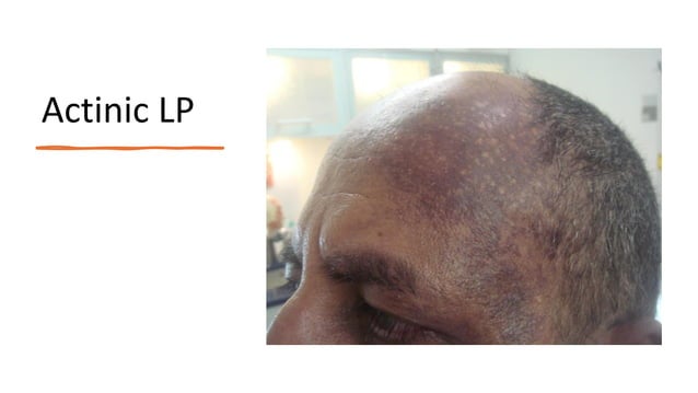 Lichen Planus disease - Dermatology speciality | PPT