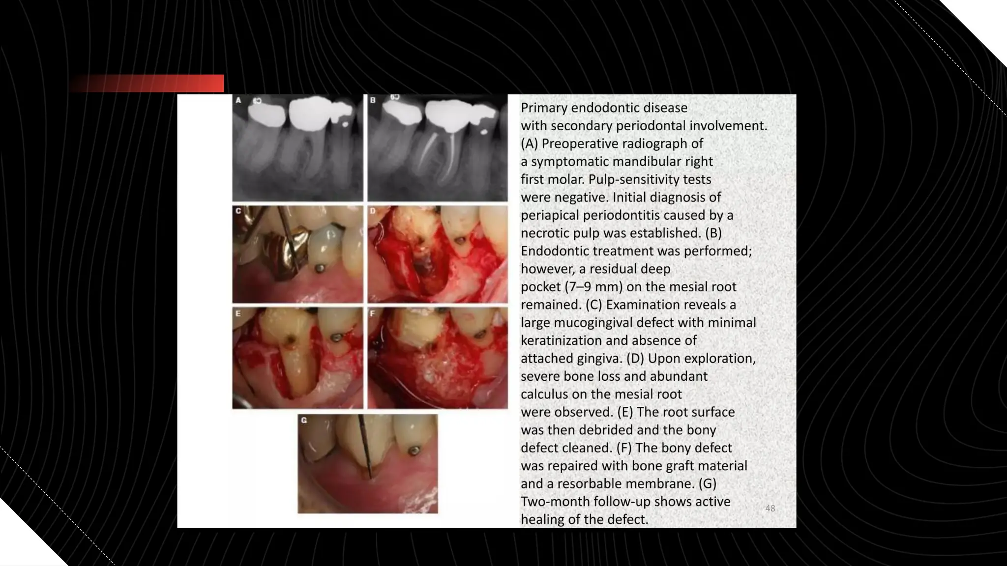 10. Periodontic-Endodontic continnum.pptx