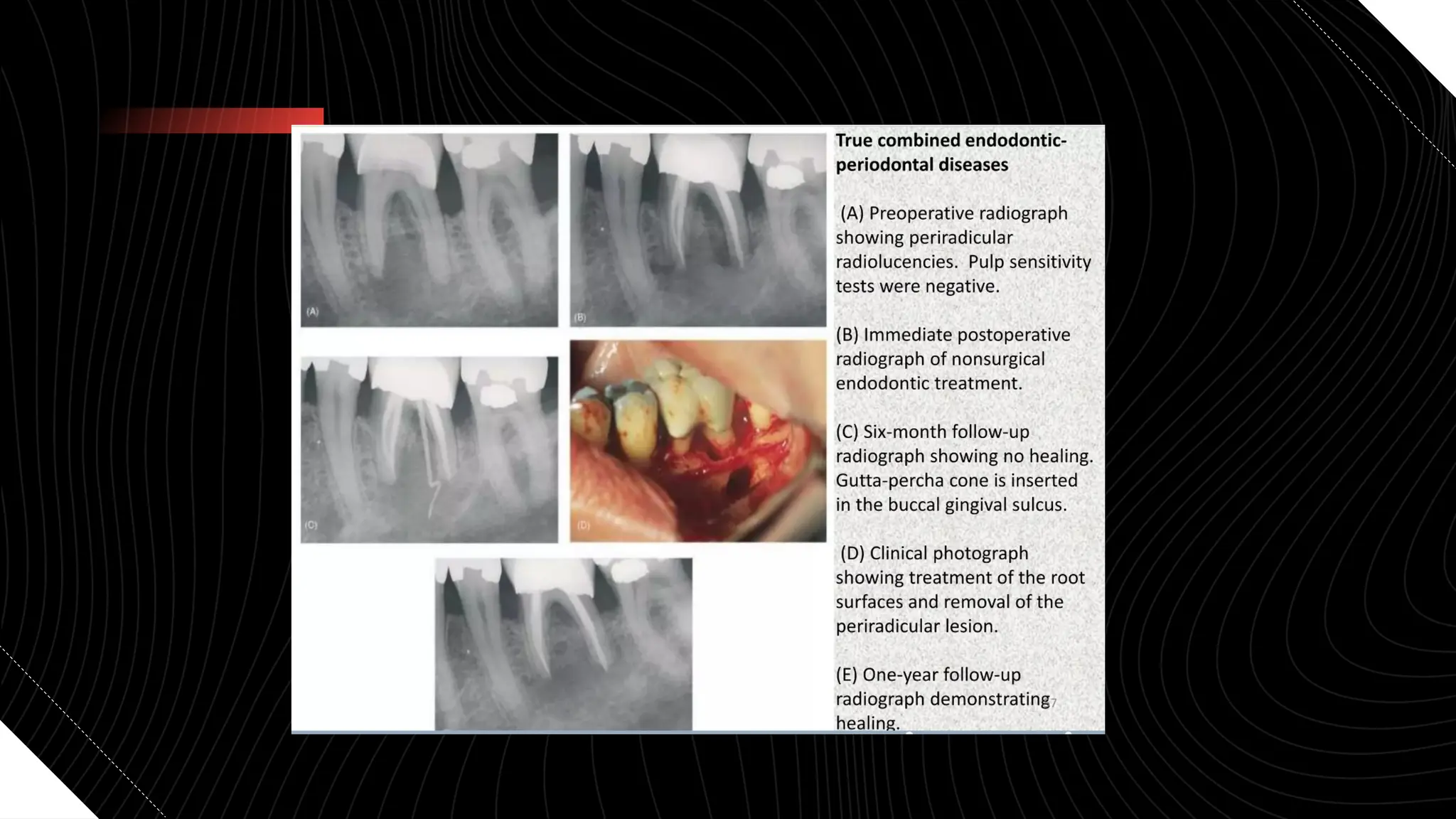 10. Periodontic-Endodontic continnum.pptx