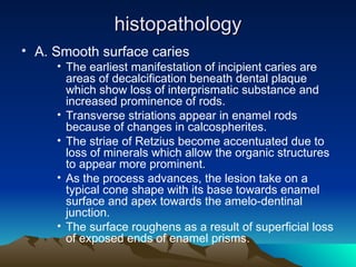 The pathogenesis of dental caries made e | PPT