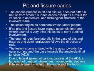 The pathogenesis of dental caries made e | PPT